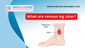 What is venous leg ulcer? | Endovascular Expert Jaipur