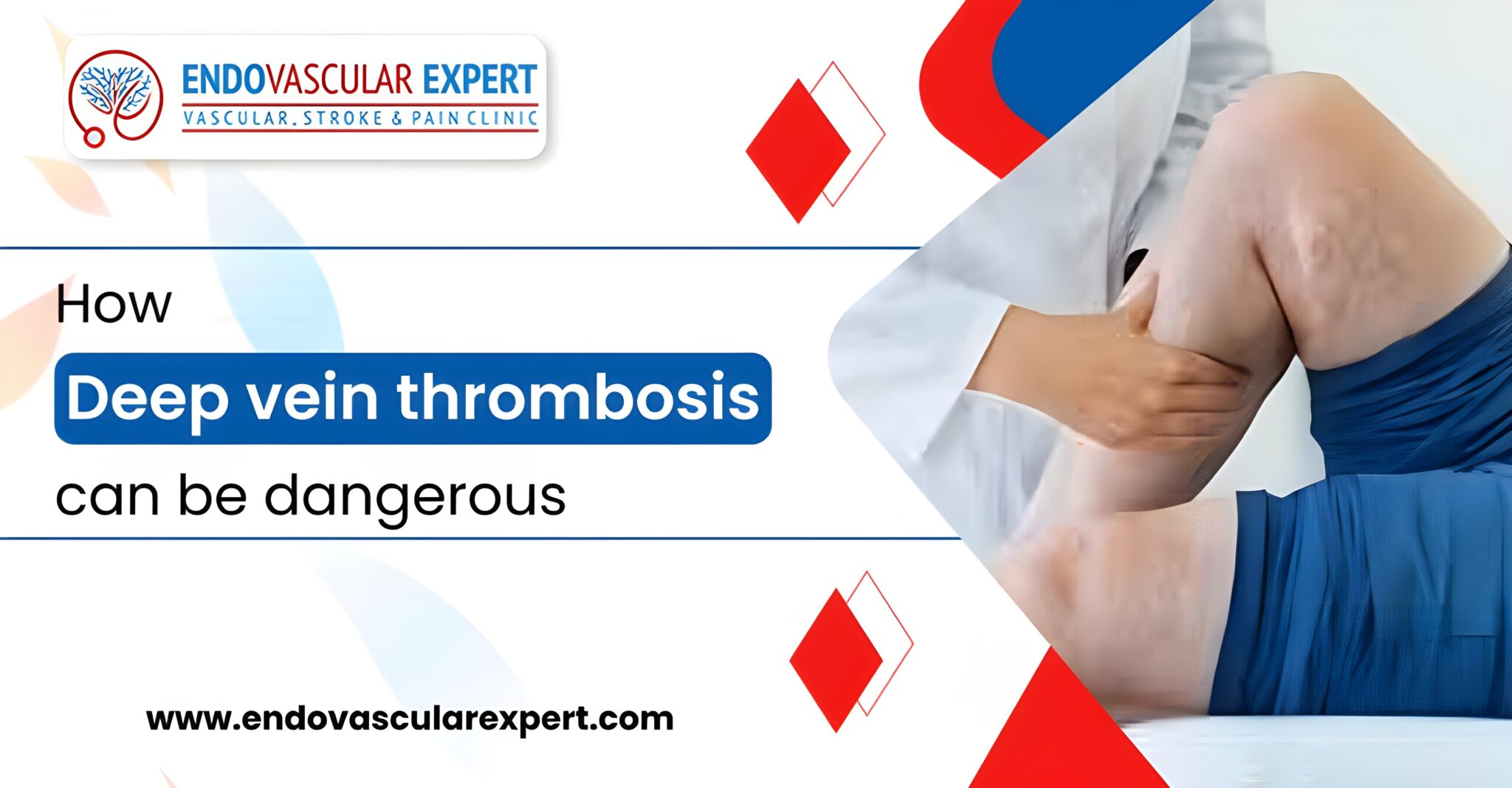 how deep vein thrombosis can be dangerous? - Endovascularexpert