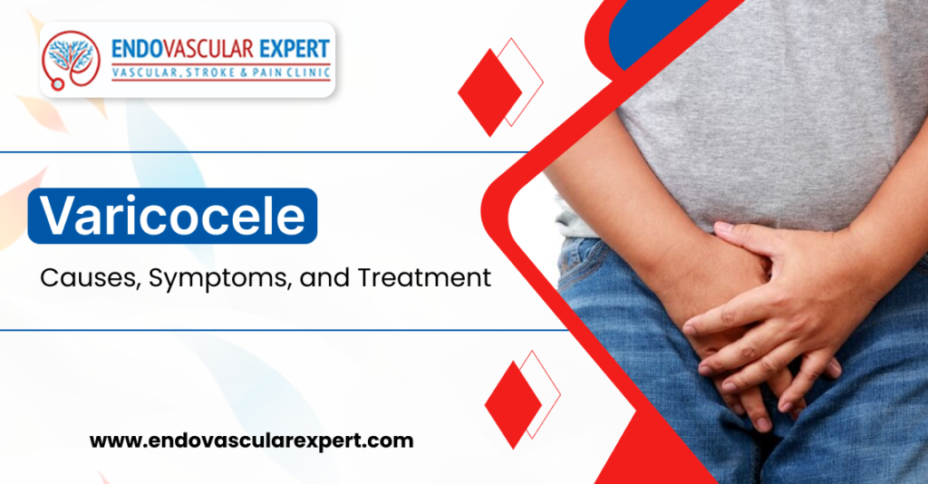 Varicocele -Causes Symptoms and Treatment !- Endovascularexpert
