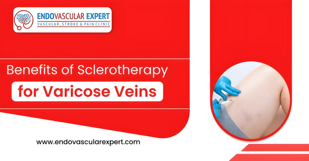 Benefits of Sclerotherapy for Varicose Veins - Endovascularexpert