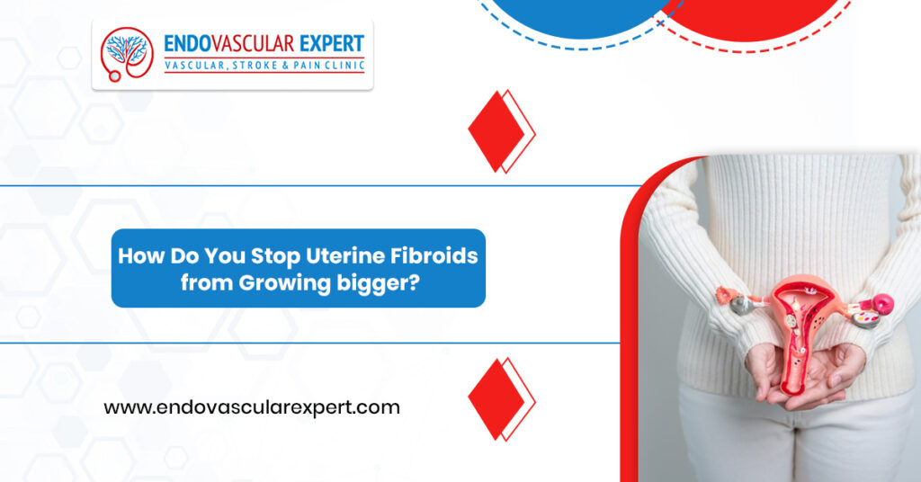 How Do You Stop Uterine Fibroids from Growing?