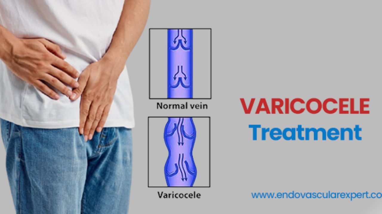 Varicocele Grade 1