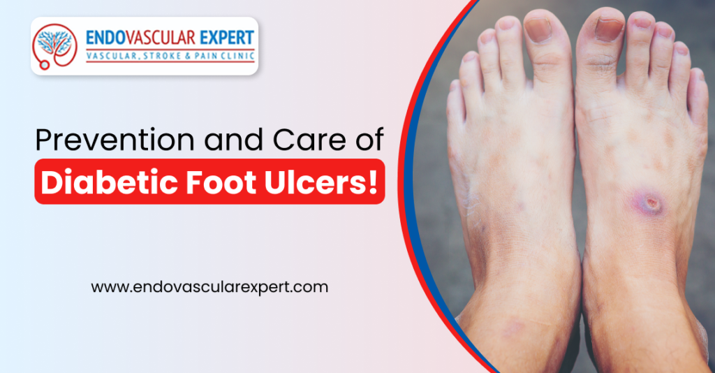 Prevention and Care of Diabetic Foot Ulcers! - Endovascular