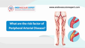 What are the risk factors of peripheral arterial disease? | Dr. Nikhil ...