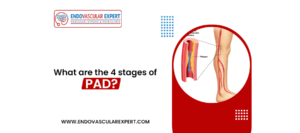 What are the 4 stages of PAD? | Endovascularexpert Clinic